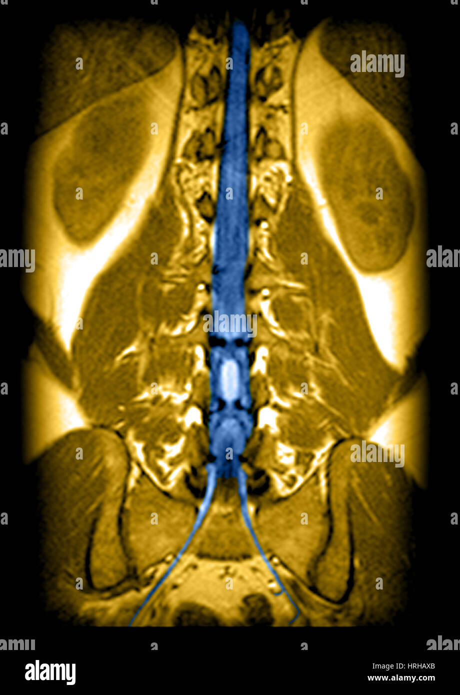 Mri of normal thoracic spinal cord hi-res stock photography and images ...