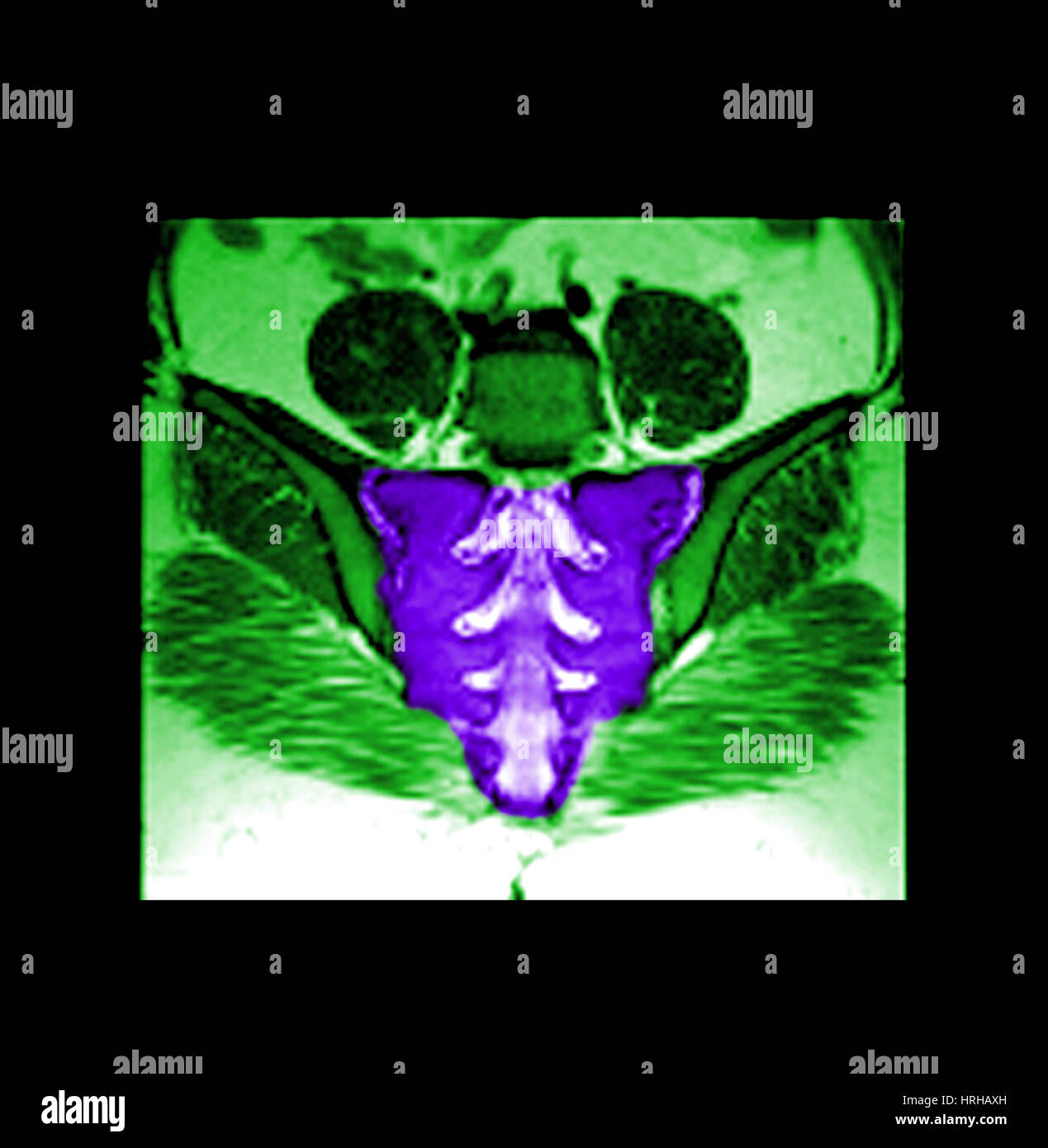 Mri of sacrum hi-res stock photography and images - Alamy