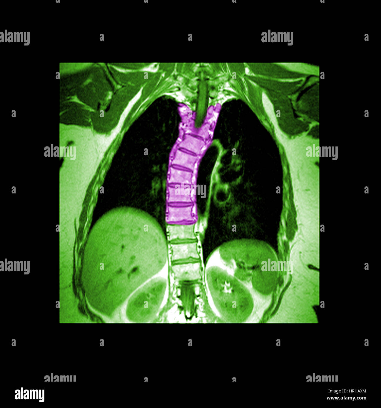 MRI of Thoracic Scoliosis Stock Photo - Alamy