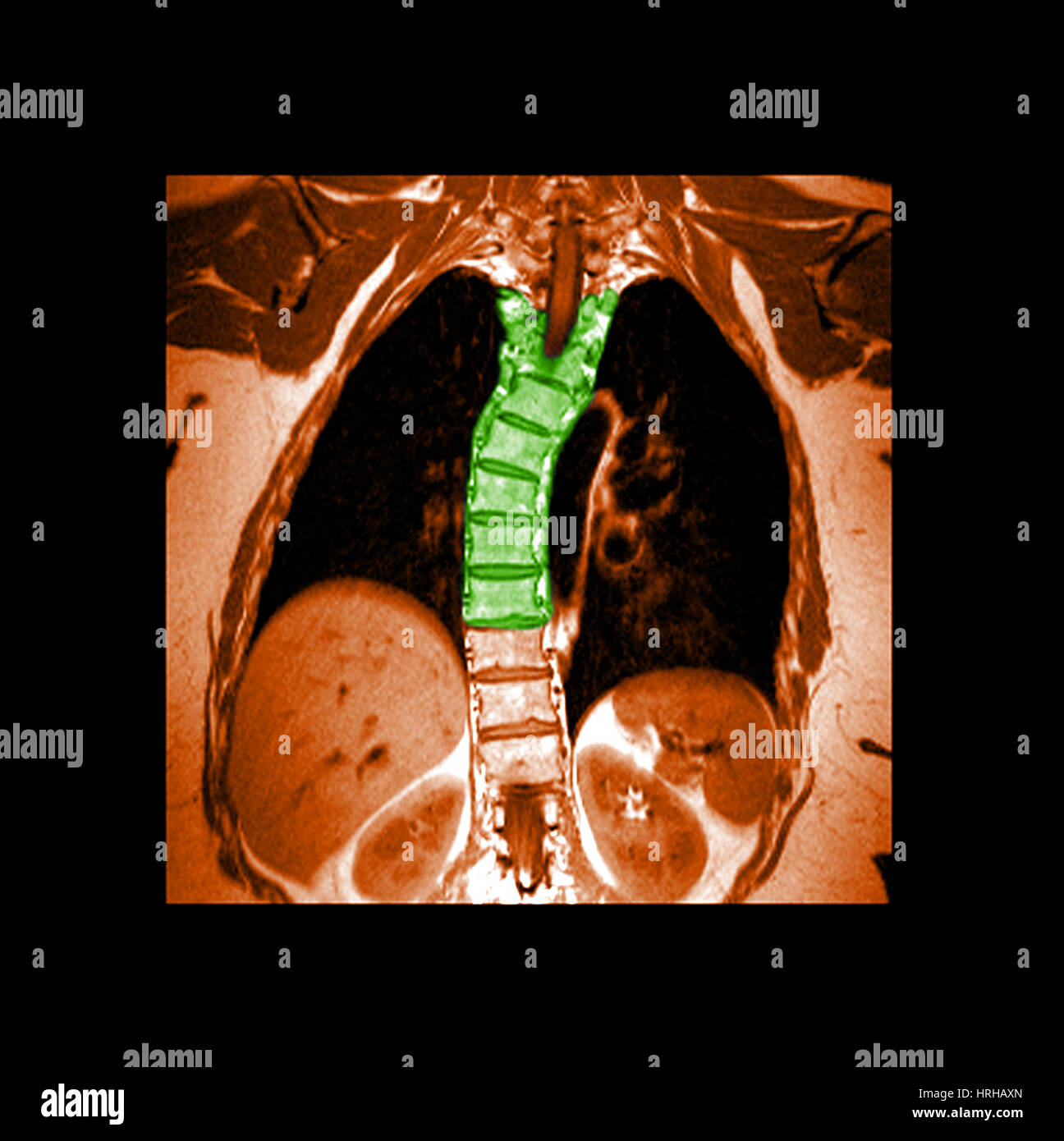 Thoracic dextroscoliosis hi-res stock photography and images - Alamy