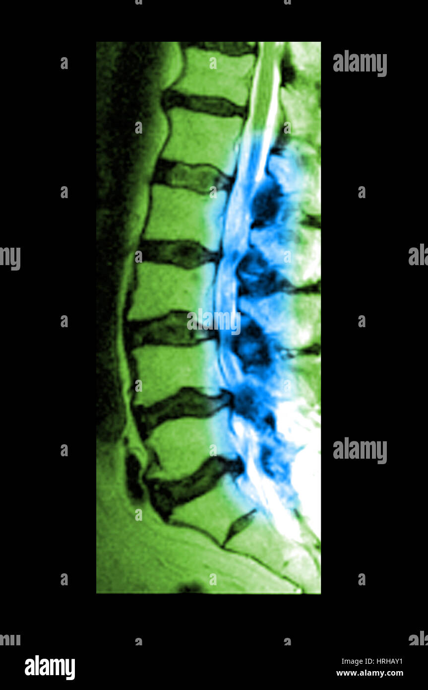 Lumbar facet joint hi-res stock photography and images - Alamy