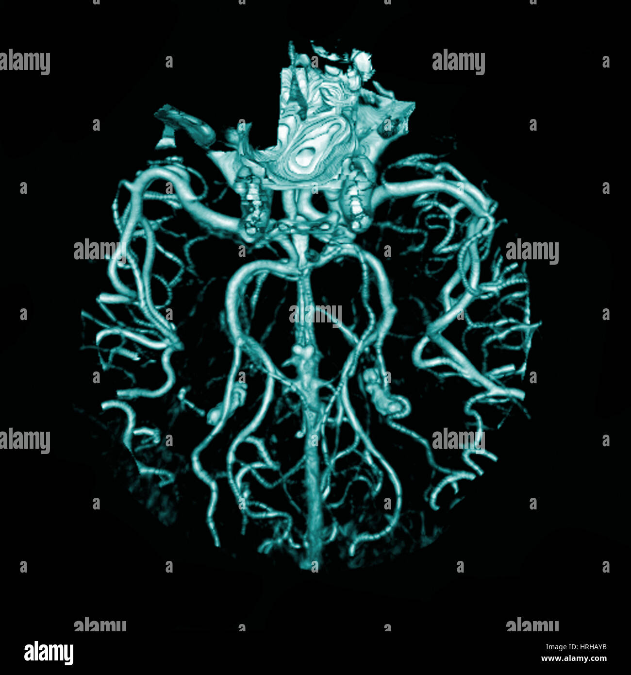 Ct angiogram hi-res stock photography and images - Alamy