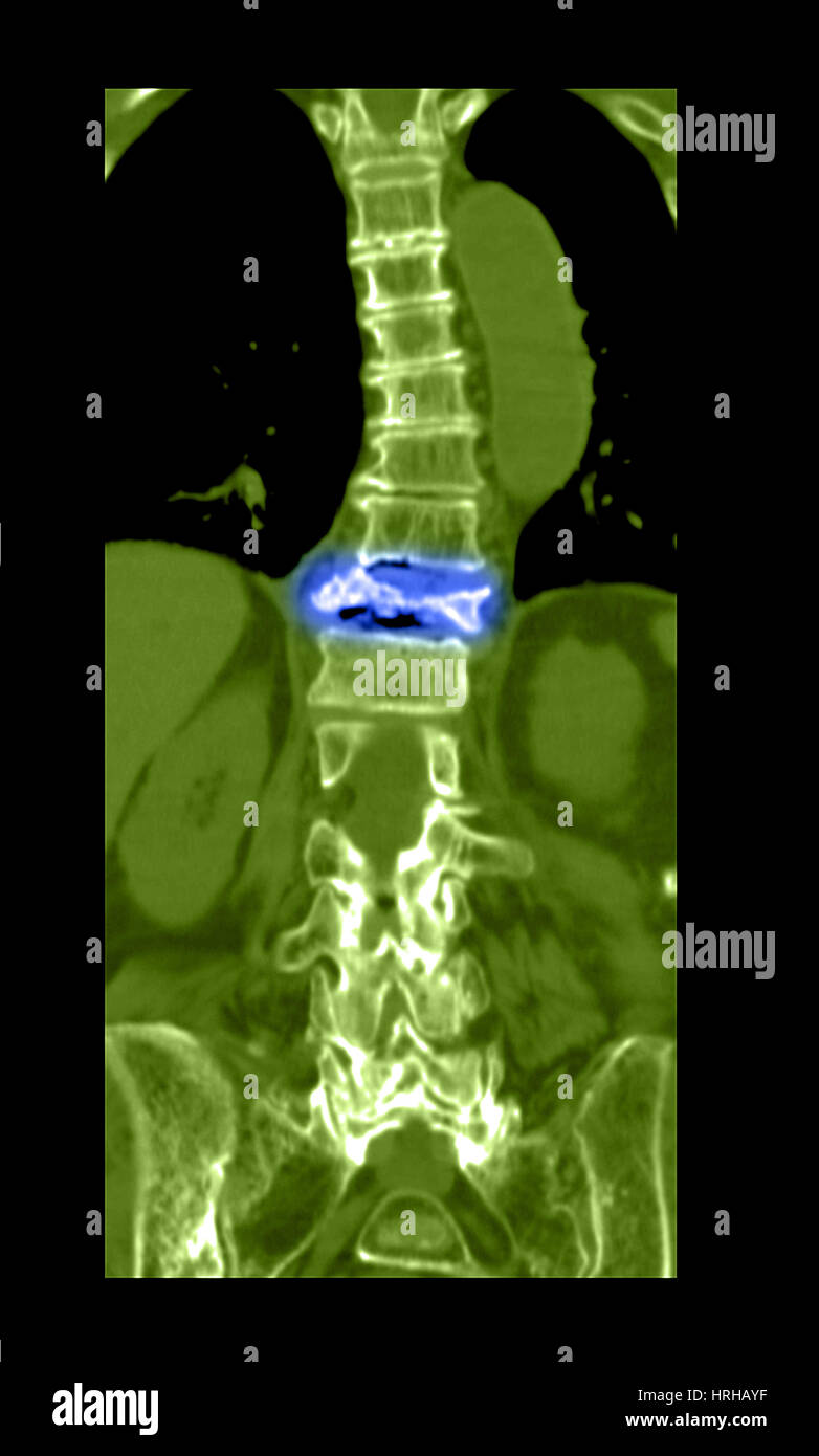 Picture of osteoporosis hi-res stock photography and images - Alamy
