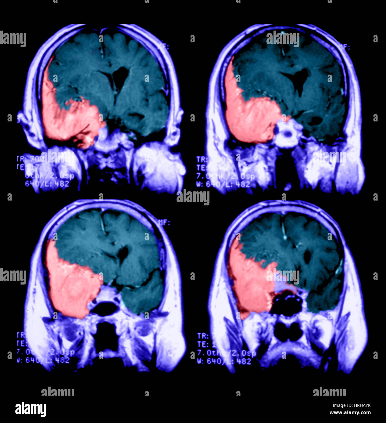 Mri meningioma hi-res stock photography and images - Alamy