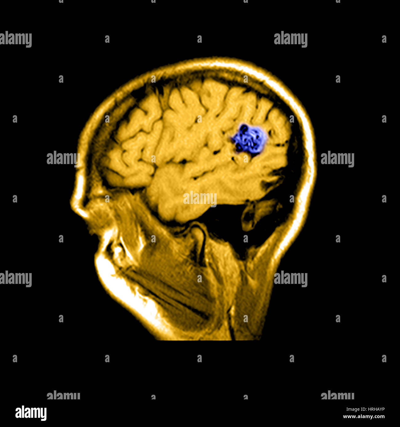 Mri congenital malformation of cerebral vessels hi-res stock ...