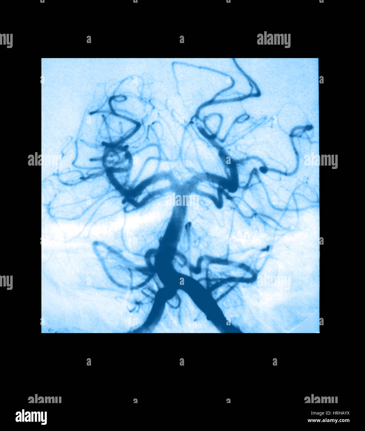 Angiogram of cerebal blood clot hi-res stock photography and images - Alamy