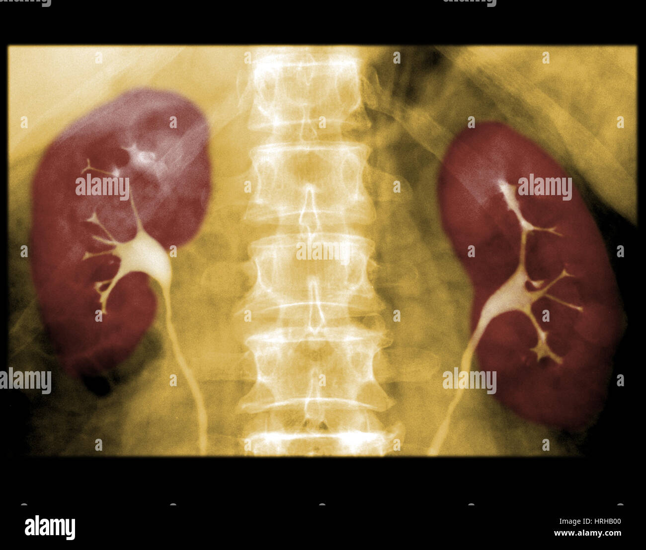 Radiography Of Kidneys Stock Photos & Radiography Of Kidneys Stock ...