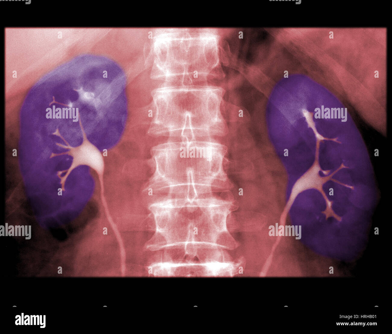 Normal xray of urinary system hi-res stock photography and images - Alamy