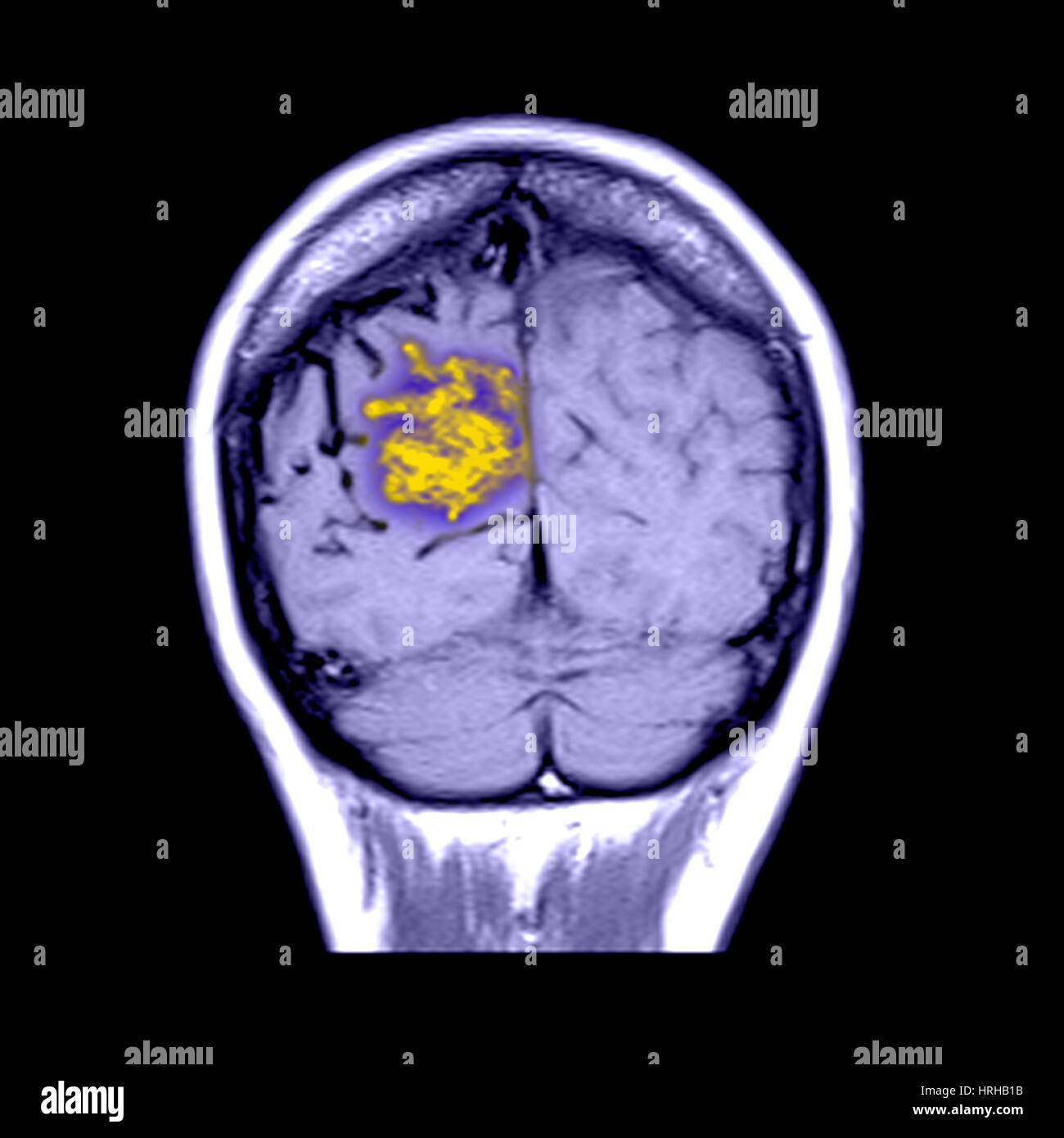 Brain arterial venous malformation hi-res stock photography and images ...