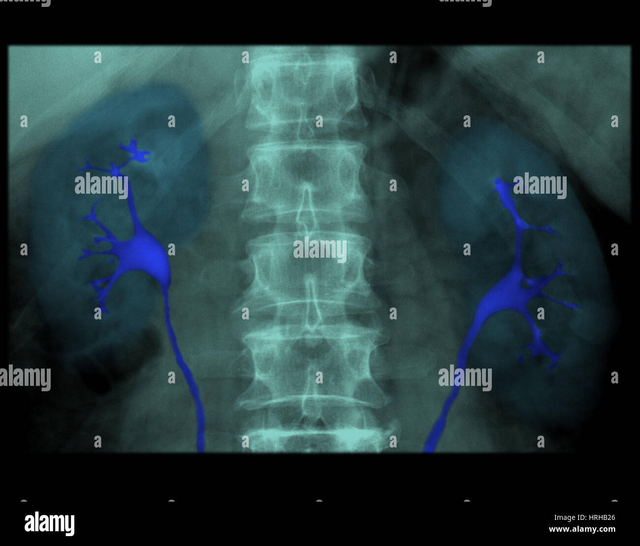 IVP of Normal Kidneys Stock Photo - Alamy