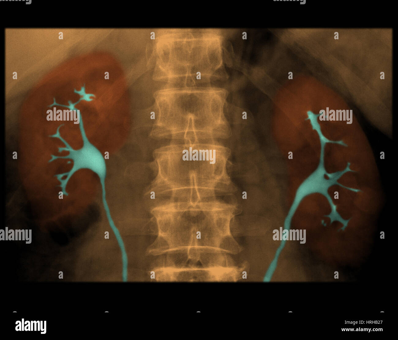 Normal urinary system ivp hi-res stock photography and images - Alamy