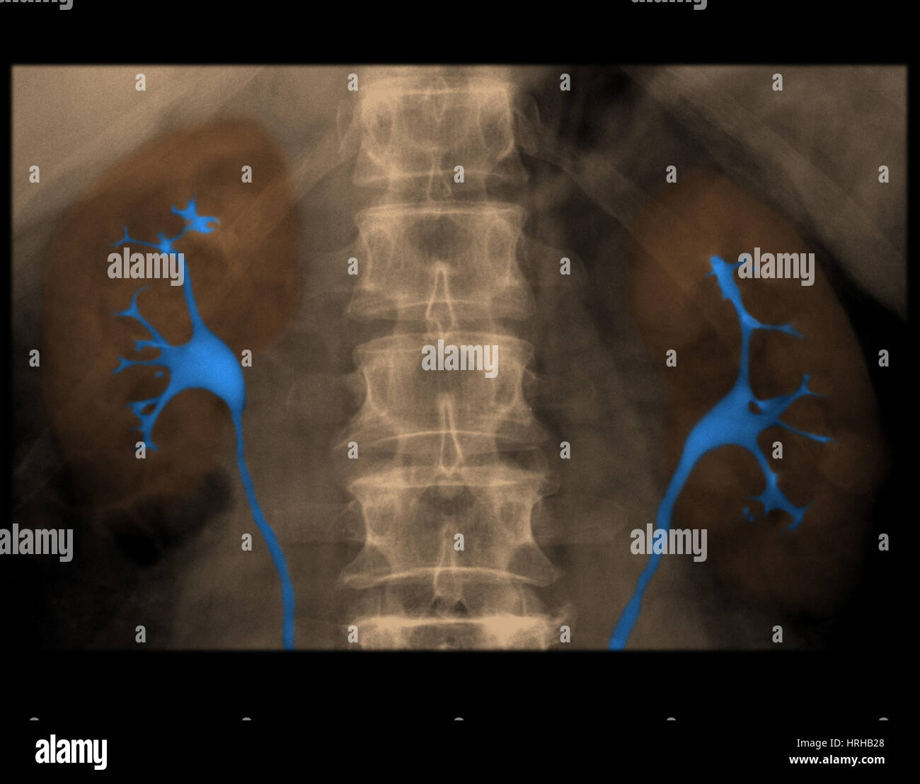 Xray of kidneys hi-res stock photography and images - Alamy