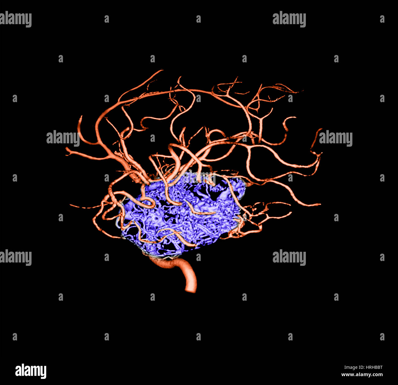 3d cerebral angiography hi-res stock photography and images - Alamy
