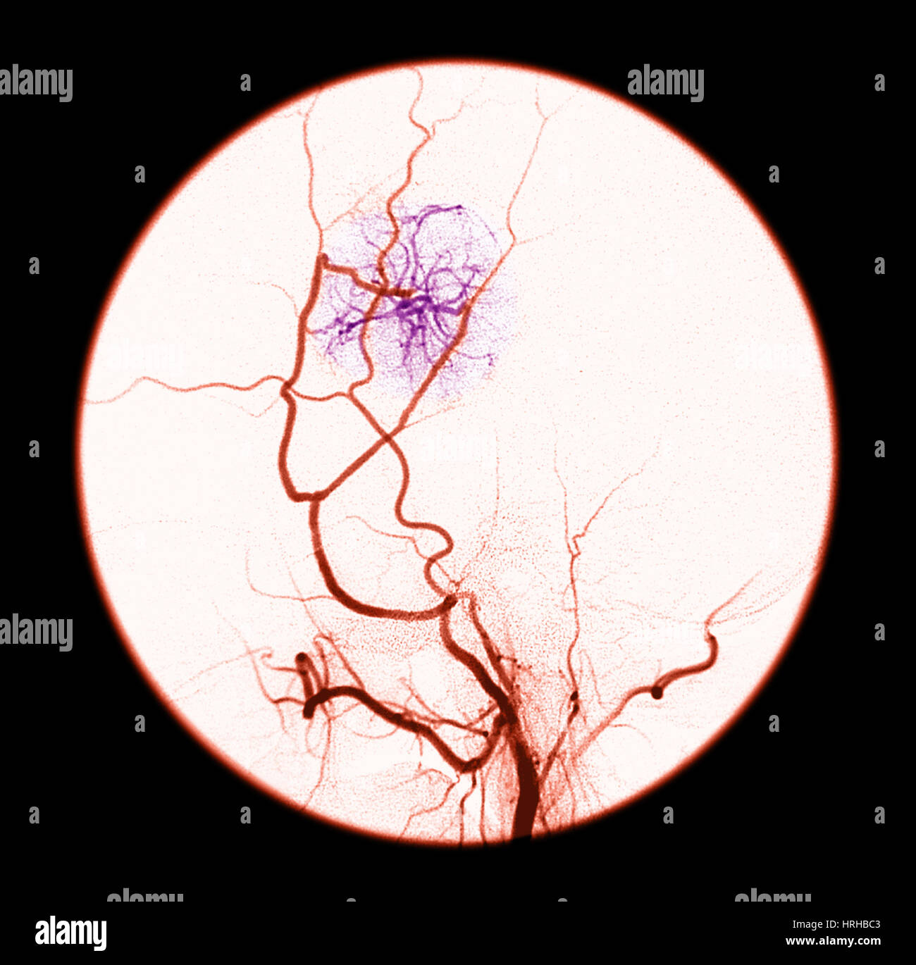 Abnormal Blood Flow Stock Photo - Alamy
