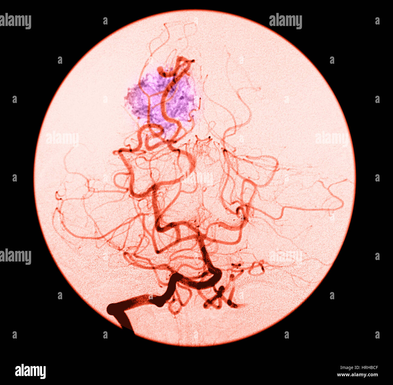 Xray of cerebral avm hi-res stock photography and images - Alamy