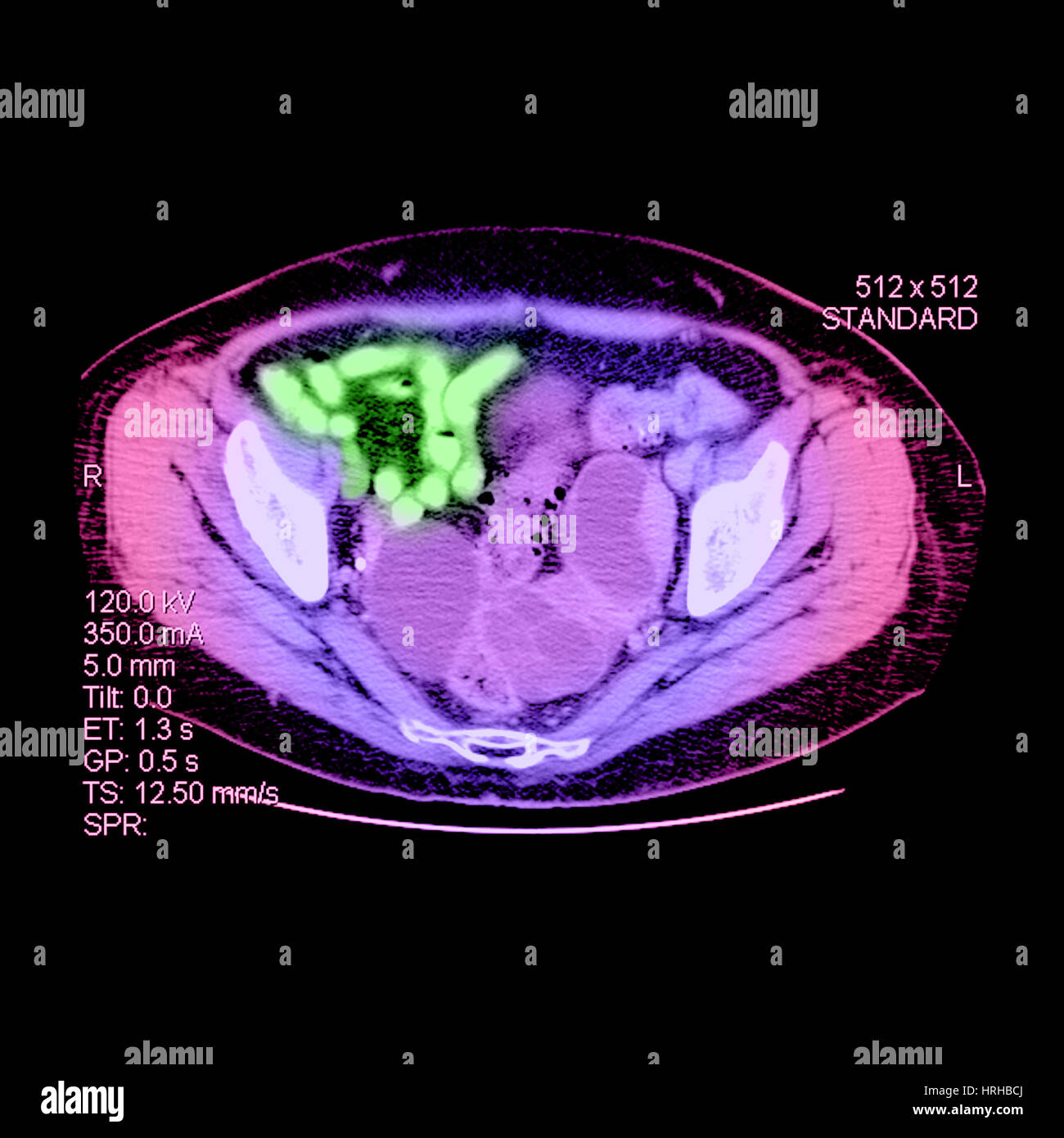 Ovarian cancer scan hi-res stock photography and images - Alamy