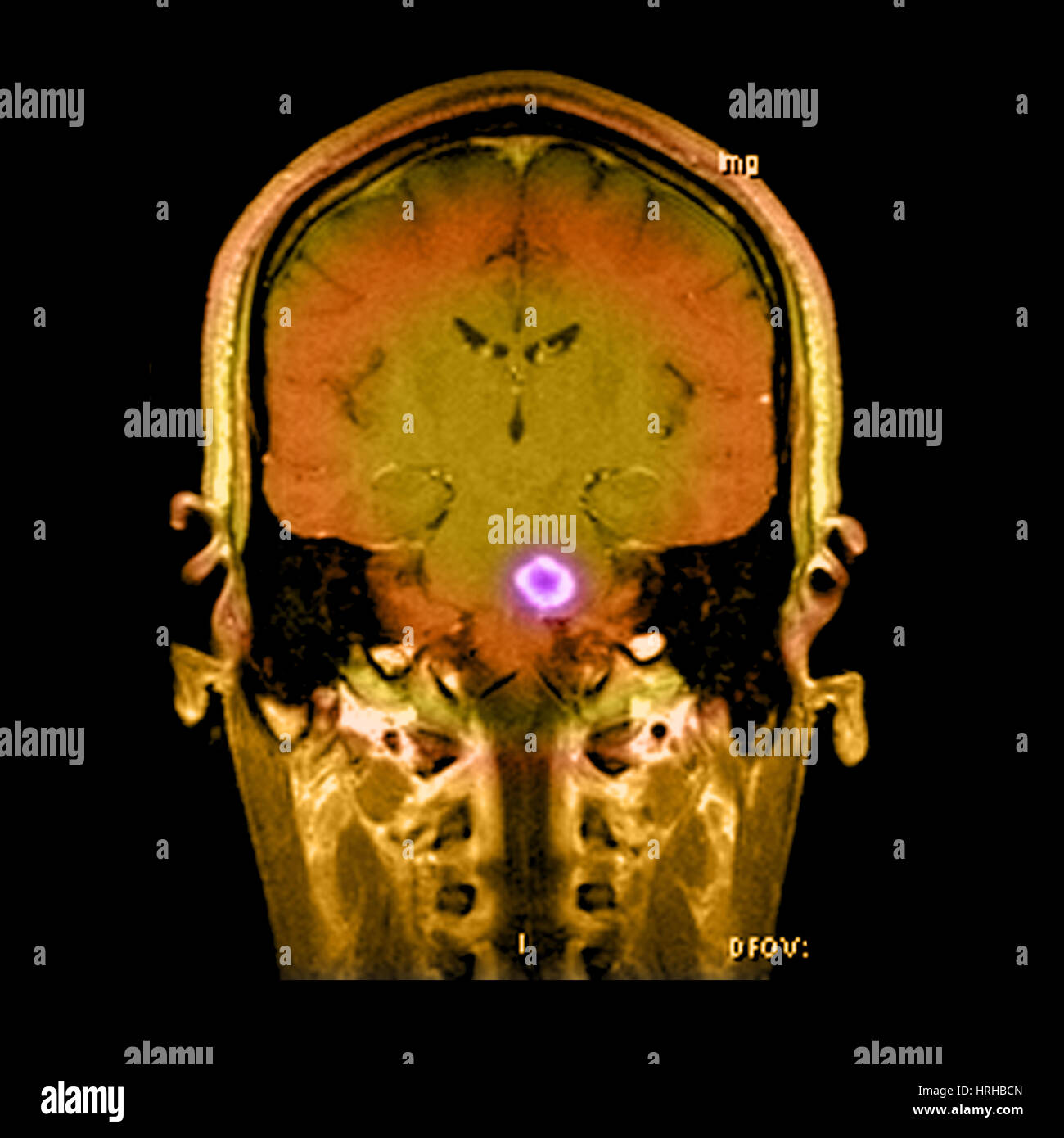 Brain stem swelling hi-res stock photography and images - Alamy