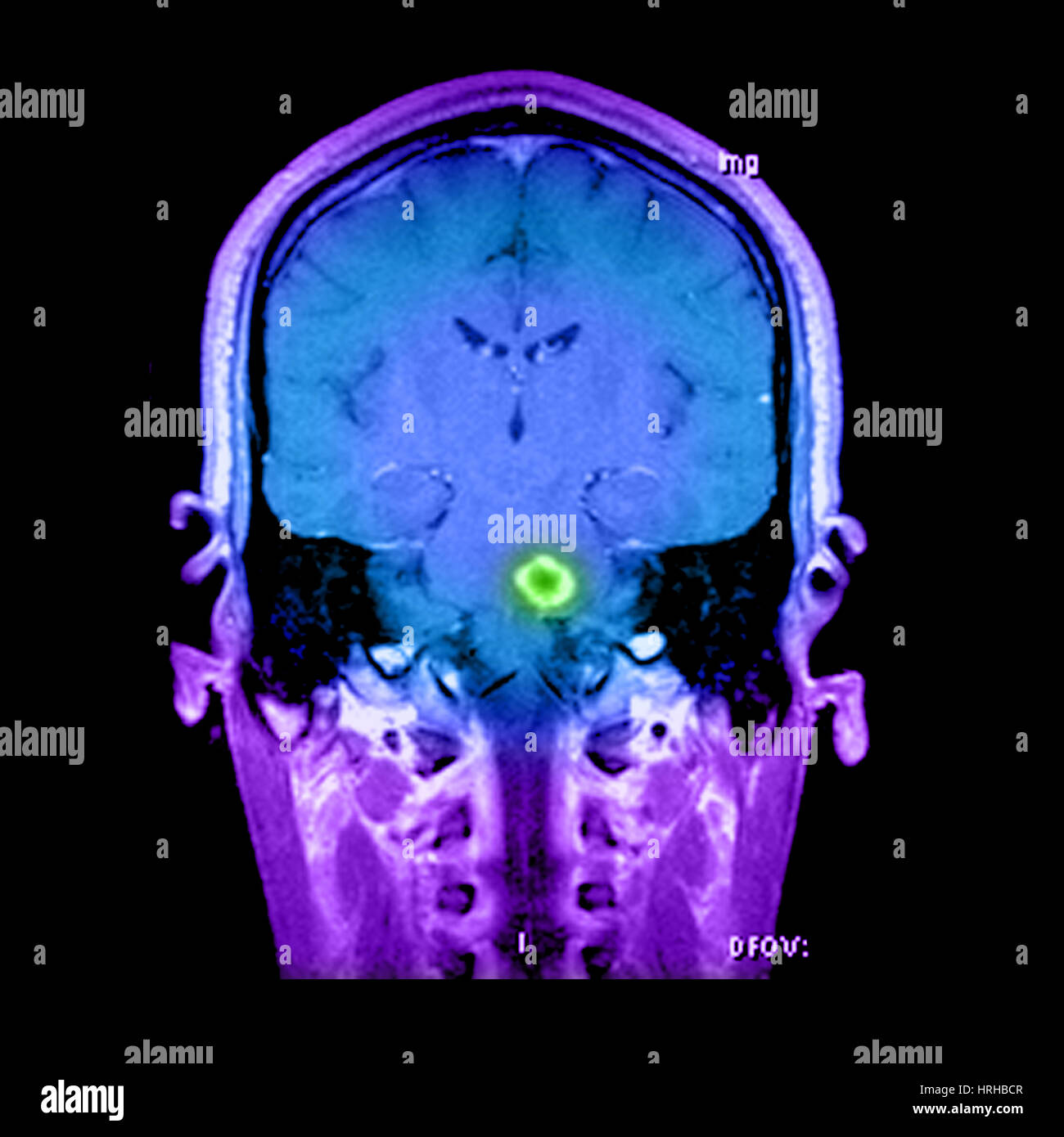 Multiple sclerosis mri scan hi-res stock photography and images - Alamy