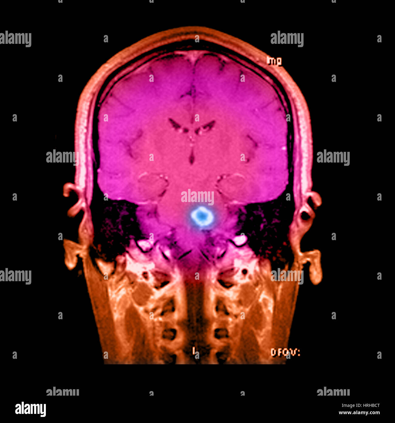 Multiple sclerosis mri scan hi-res stock photography and images - Alamy