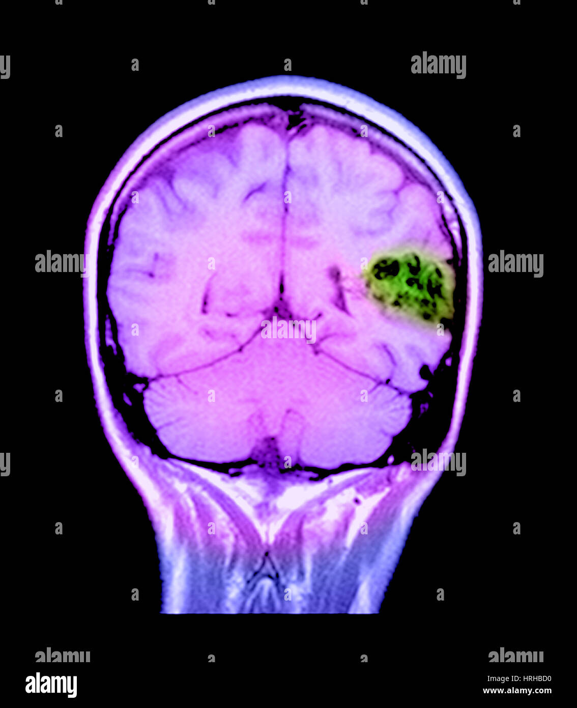 Brain arterial venous malformation hi-res stock photography and images ...