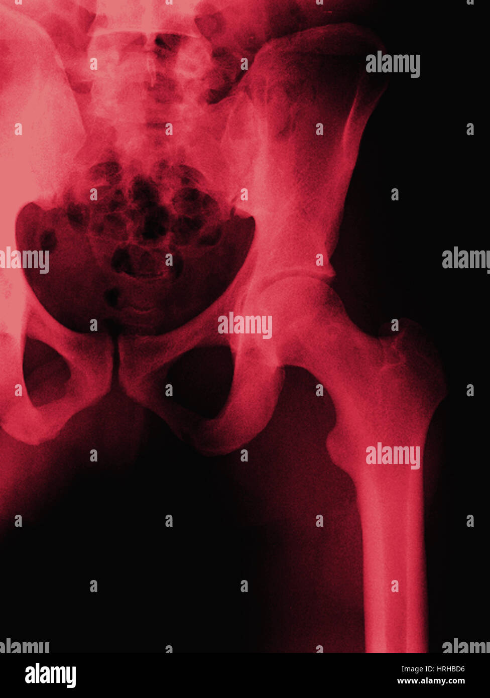 Normal hip x ray hi-res stock photography and images - Alamy