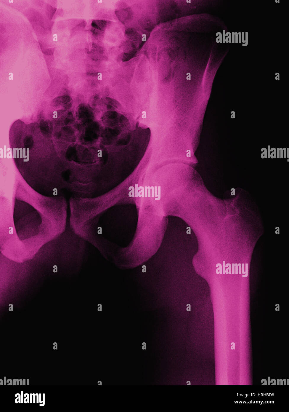 Hip socket hi-res stock photography and images - Alamy