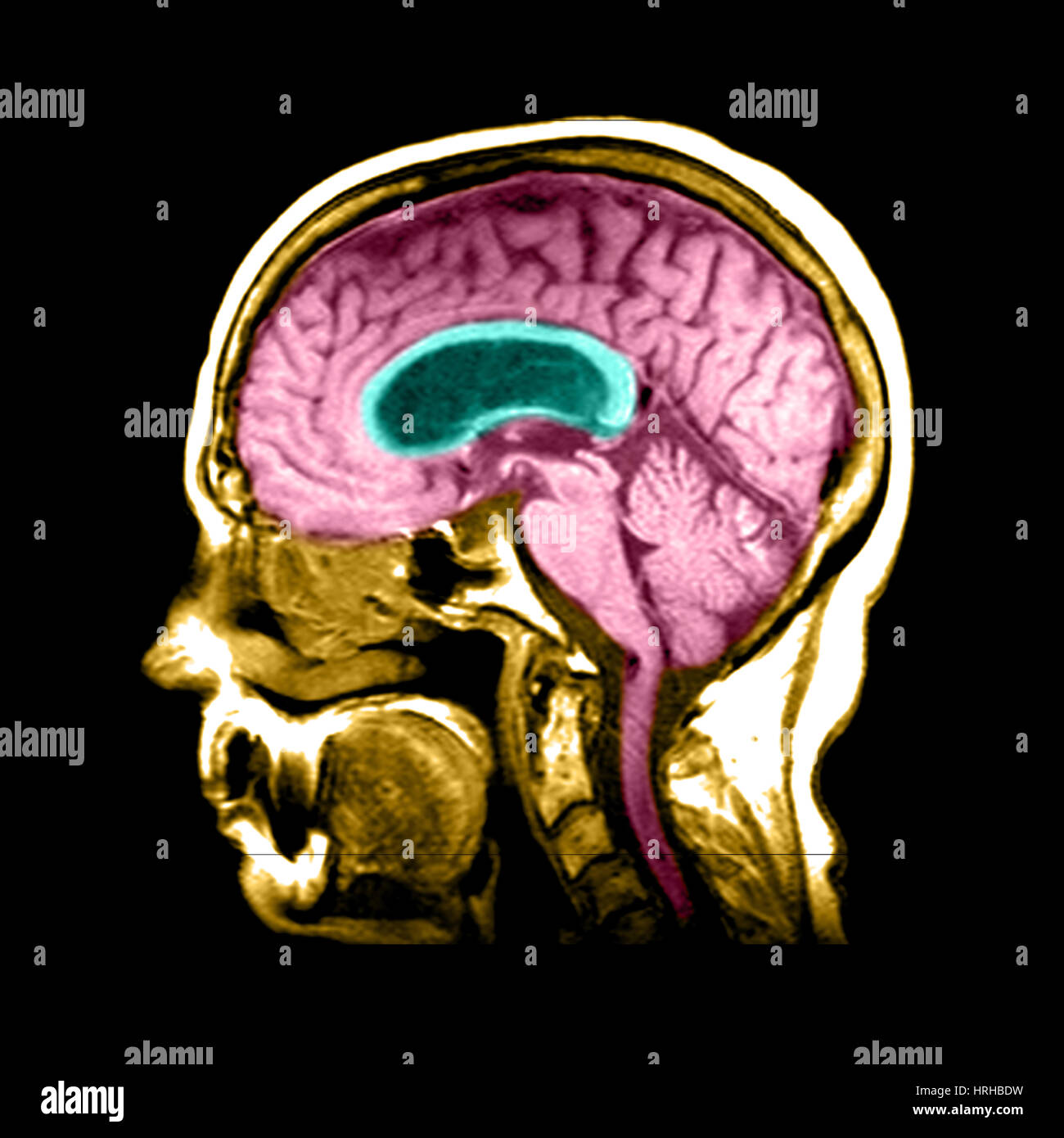 Shunt brain hi-res stock photography and images - Alamy