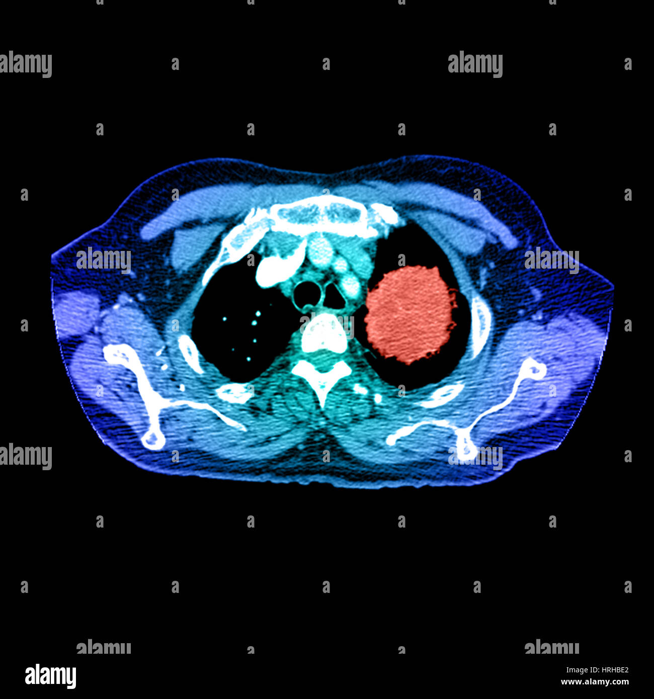 This Image Shows A Cross Section Of The Lungs Which Reveals The Main