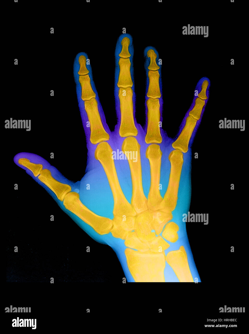 X-Ray of a Hand Stock Photo - Alamy