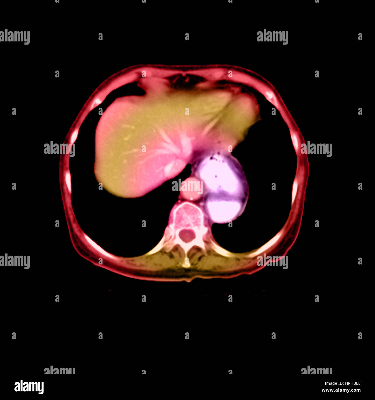 Hiatal hernia hi-res stock photography and images - Alamy