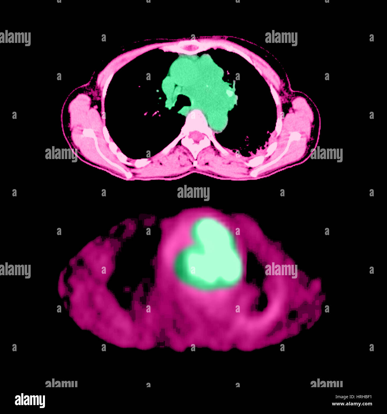 Metastatic Lymph Node Mass Stock Photo - Alamy