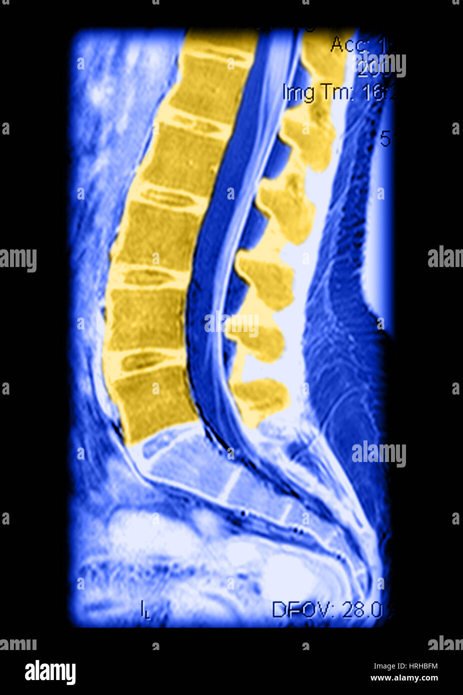 Normal Lumbar Spine Stock Photo - Alamy