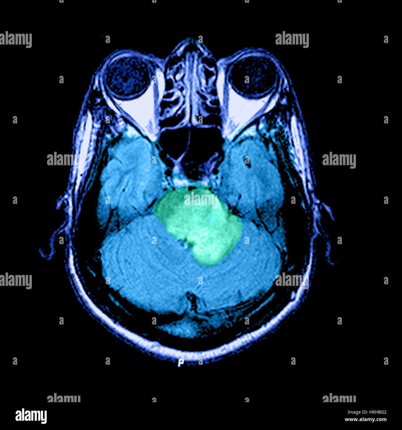 Multiple sclerosis mri scan hi-res stock photography and images - Alamy