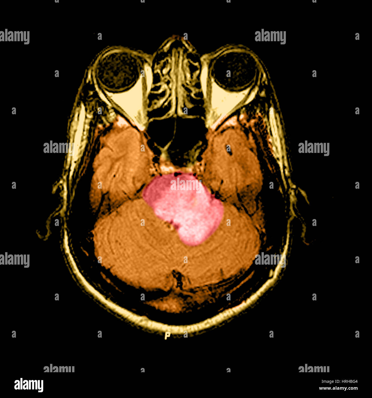 Brain stem swelling hi-res stock photography and images - Alamy