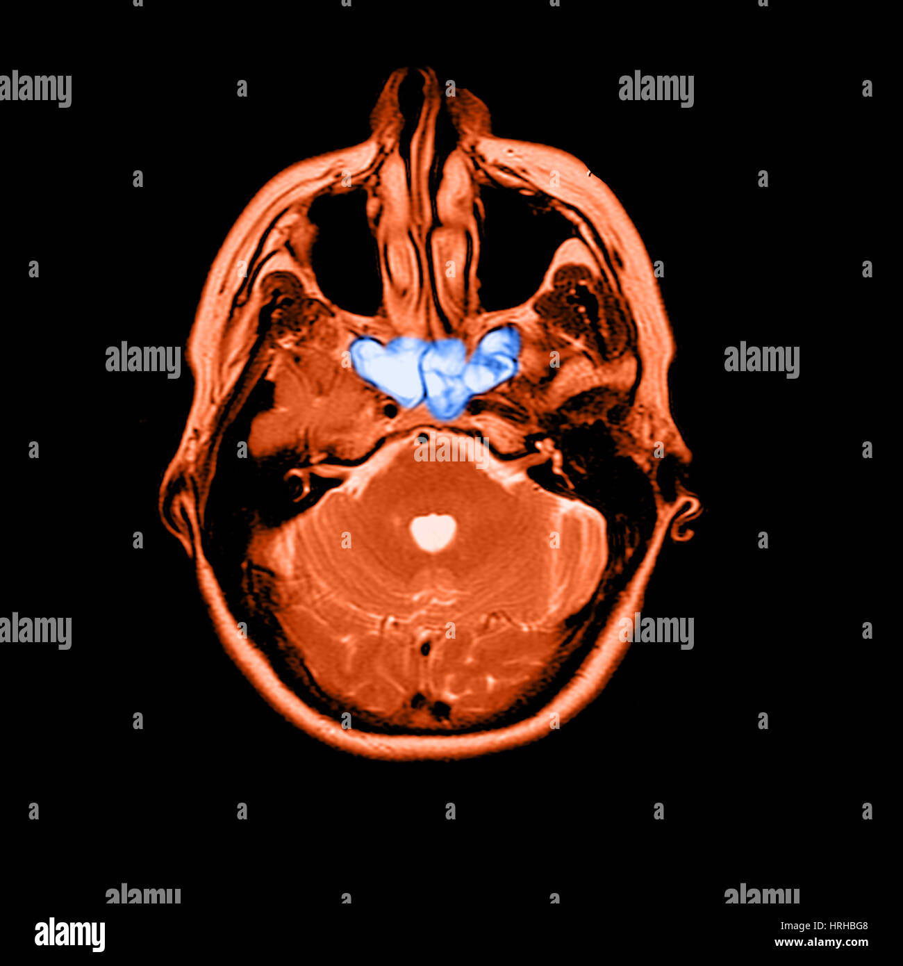 Sinus ct scan hi-res stock photography and images - Alamy