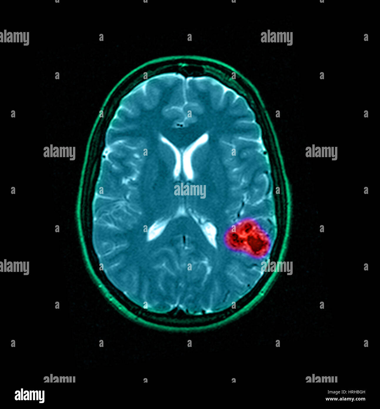 MRI of Brain AVM Stock Photo - Alamy