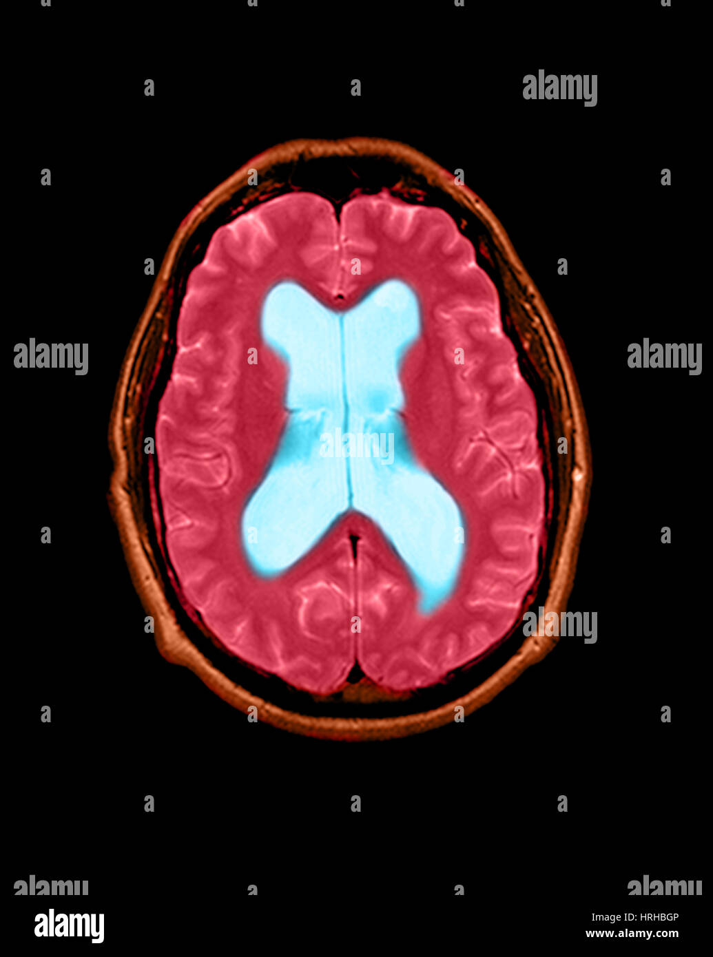 Hydrocephalus hi-res stock photography and images - Alamy