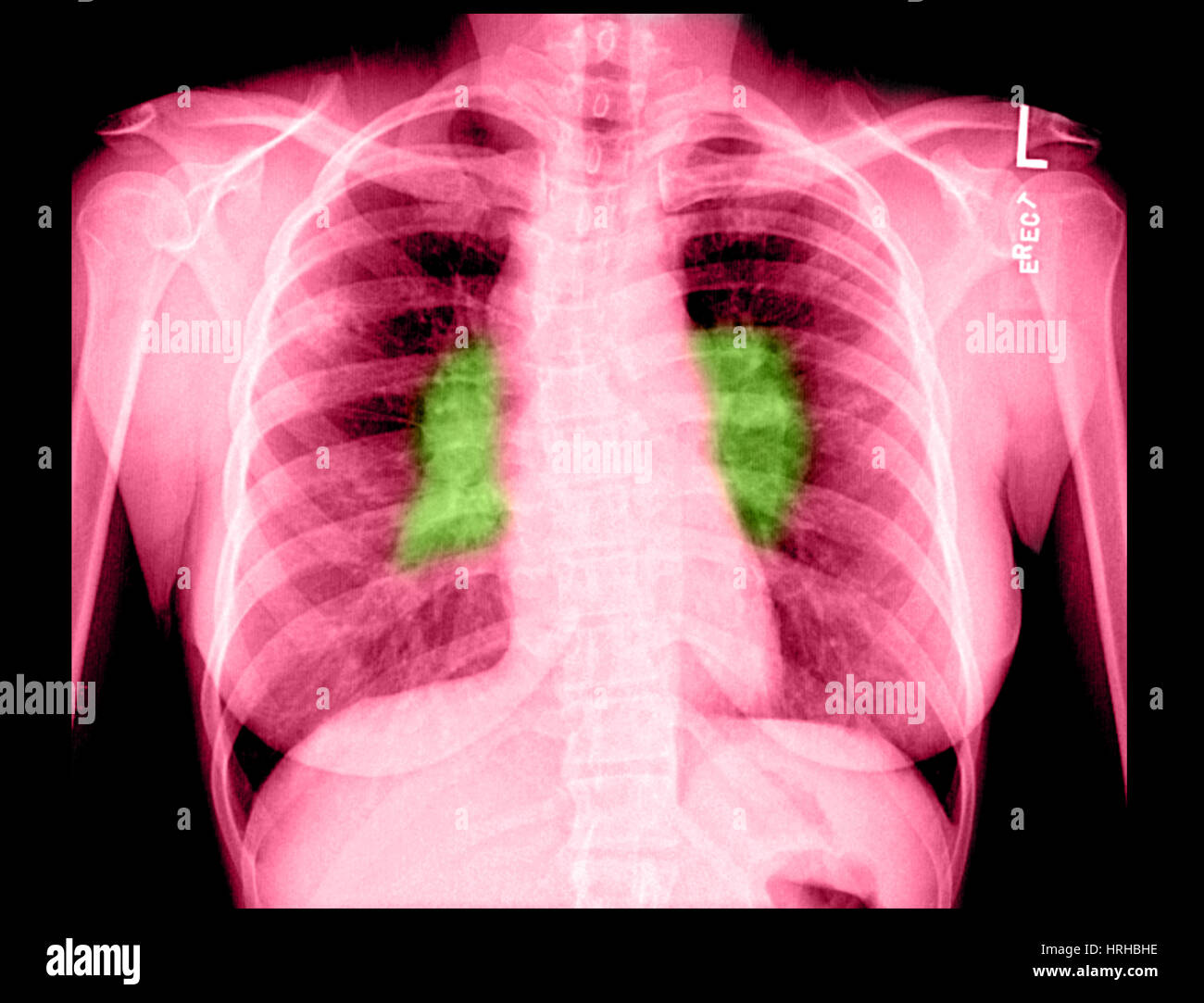 Mediastinal Lymphadenopathy