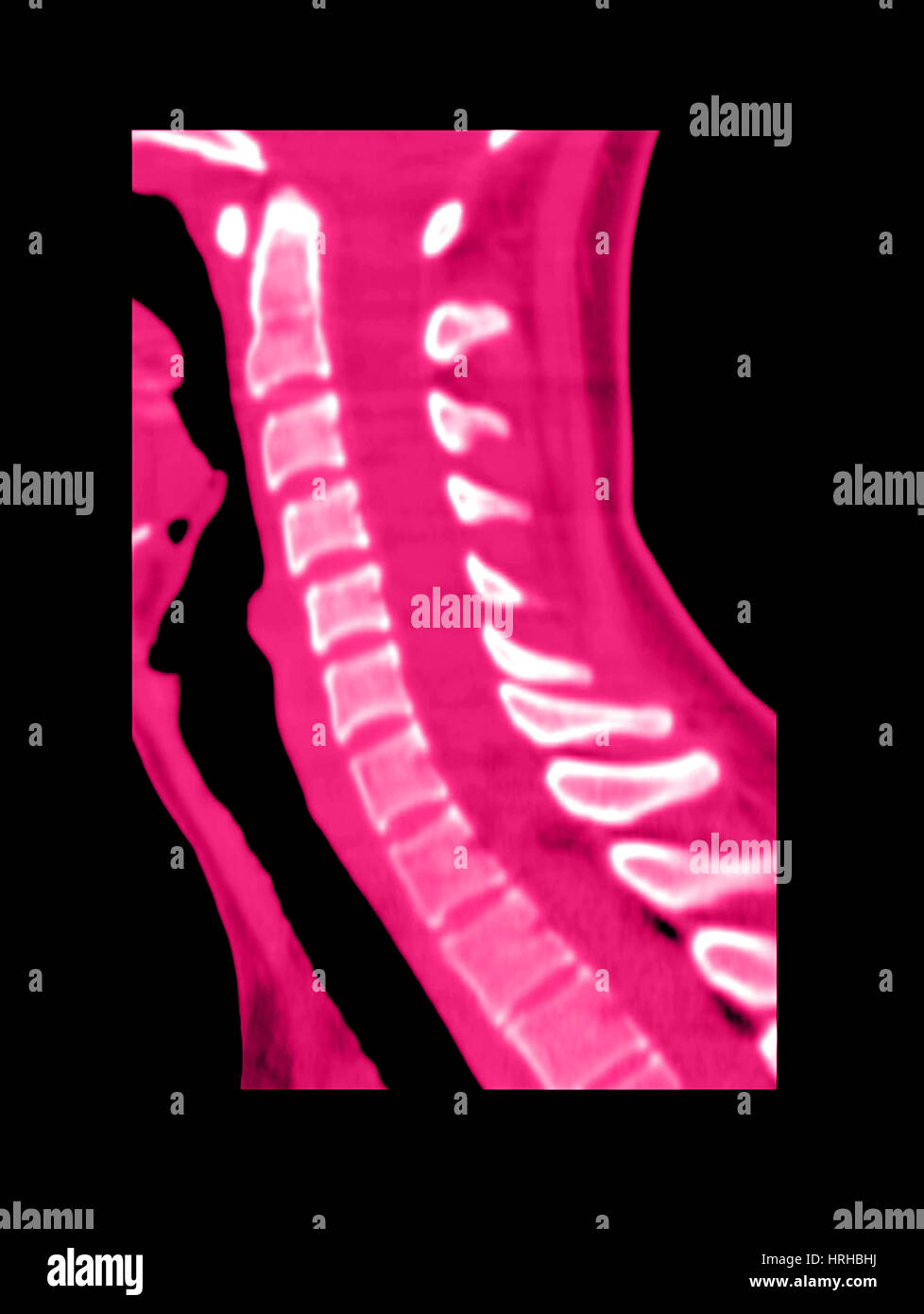 Ct of the cervical spine hi-res stock photography and images - Alamy