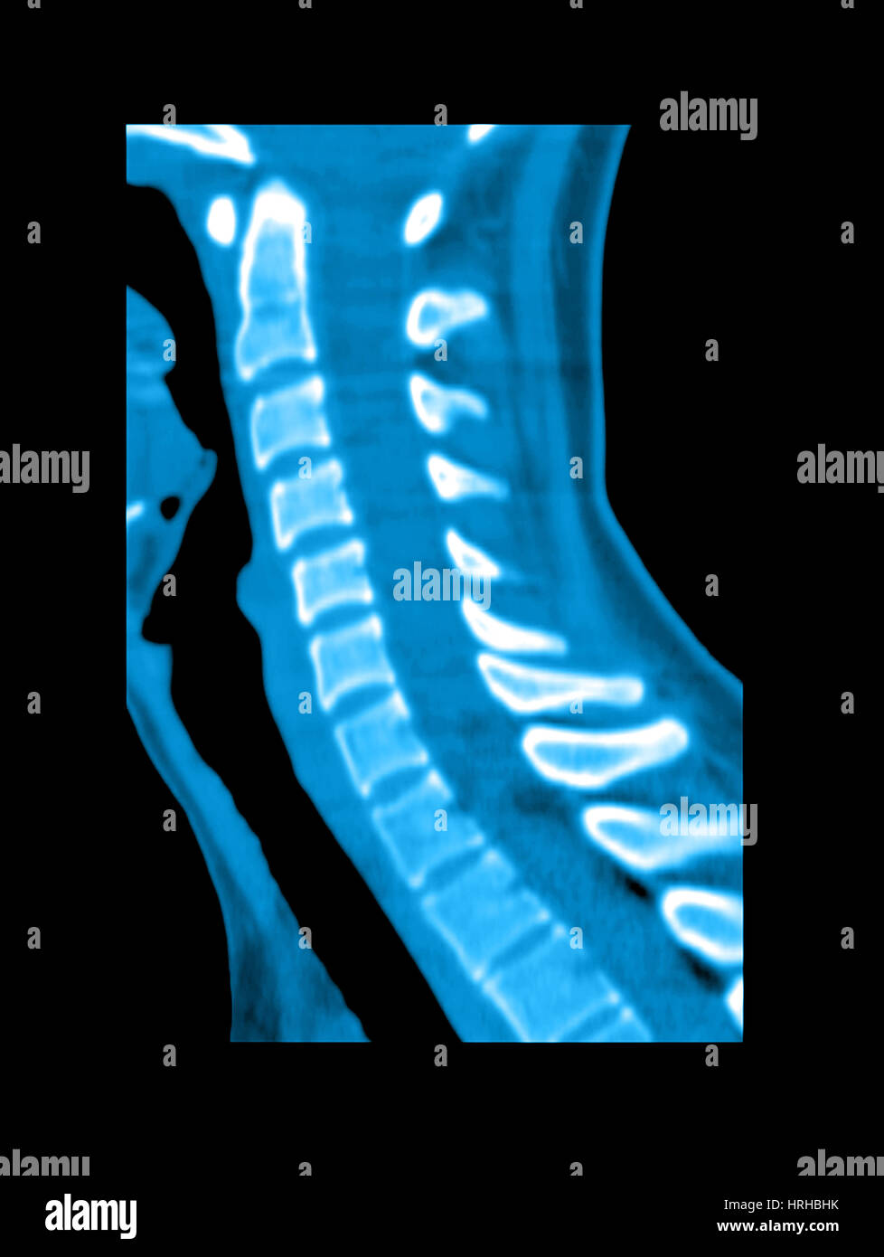 Cat scan of the cervical spine hi-res stock photography and images - Alamy