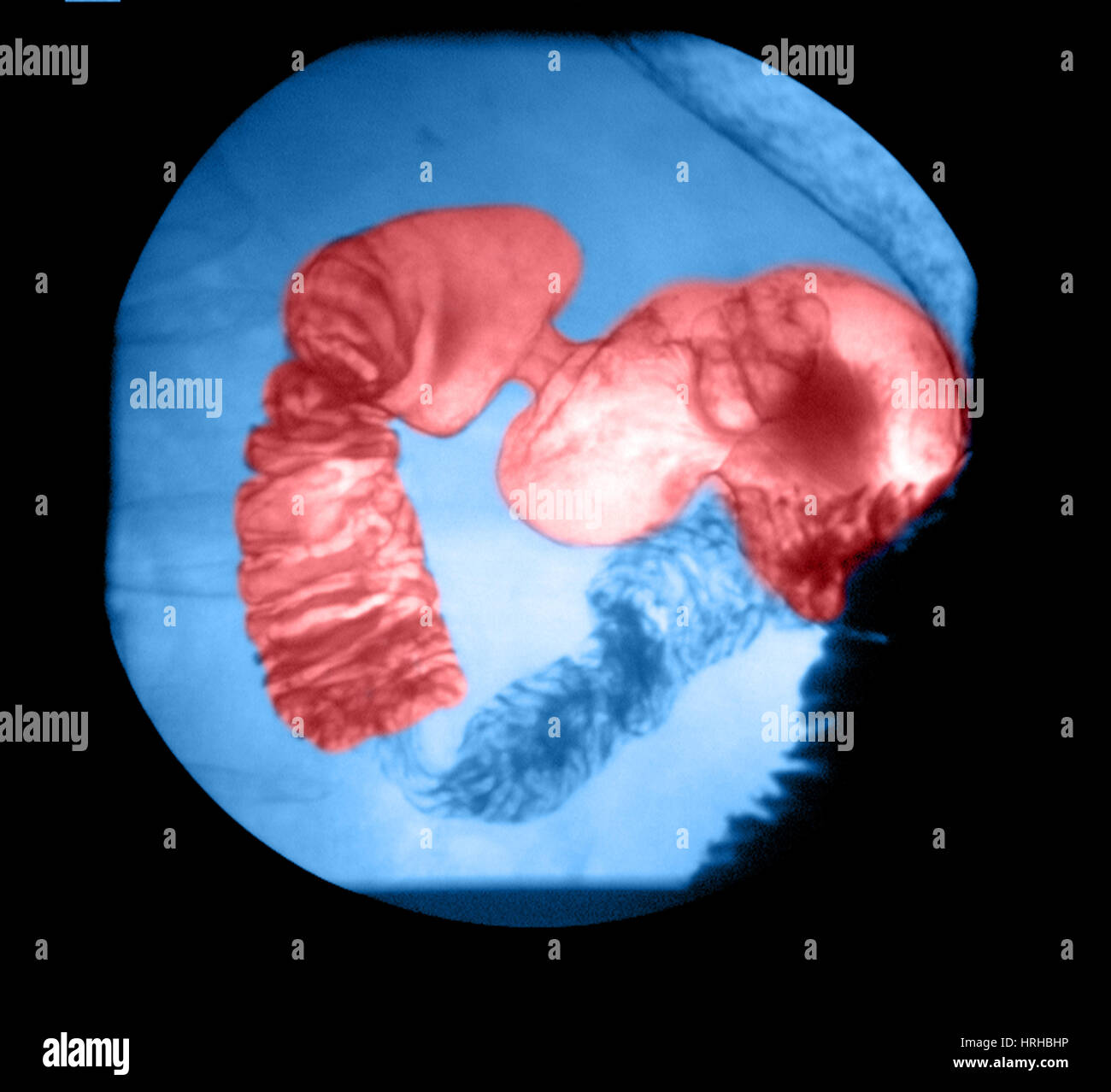 Distal Stomach and Duodenum Stock Photo - Alamy