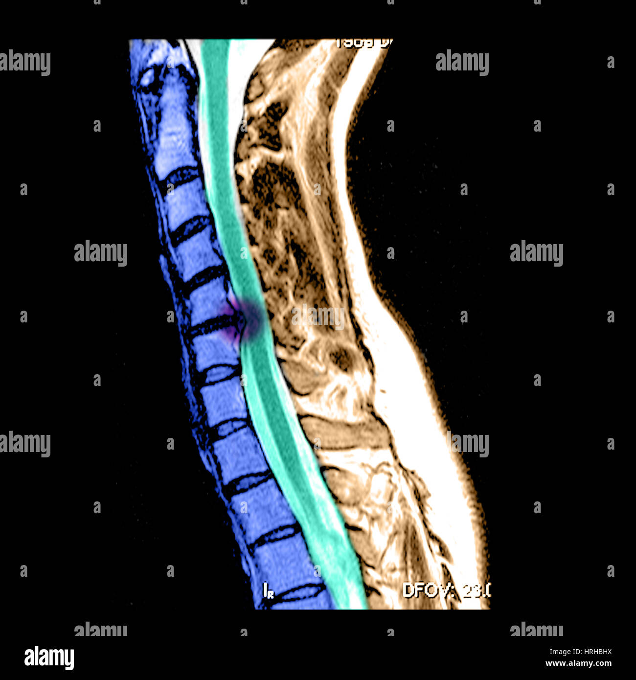 Herniated disc hi-res stock photography and images - Alamy