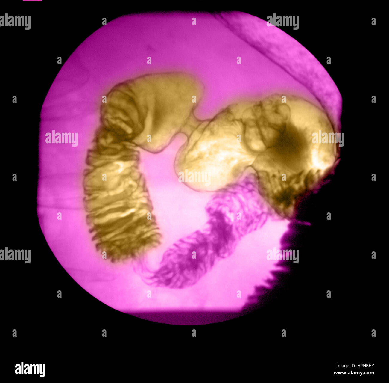 Distal Stomach and Duodenum Stock Photo - Alamy