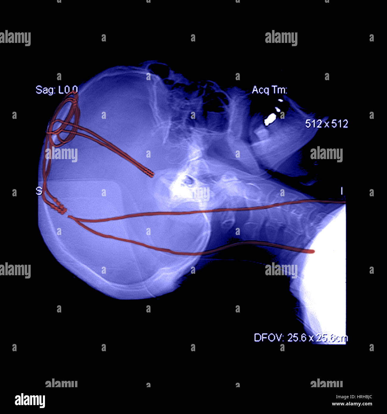 Deep brain stimulation electrodes hi-res stock photography and images ...