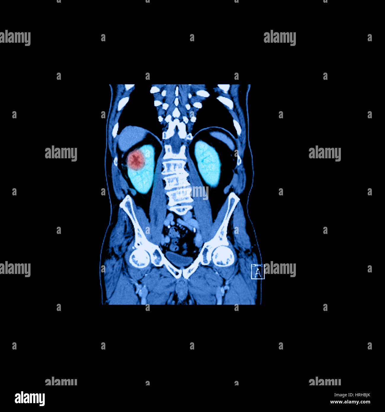 CT Reconstruction of Renal Cancer Stock Photo - Alamy