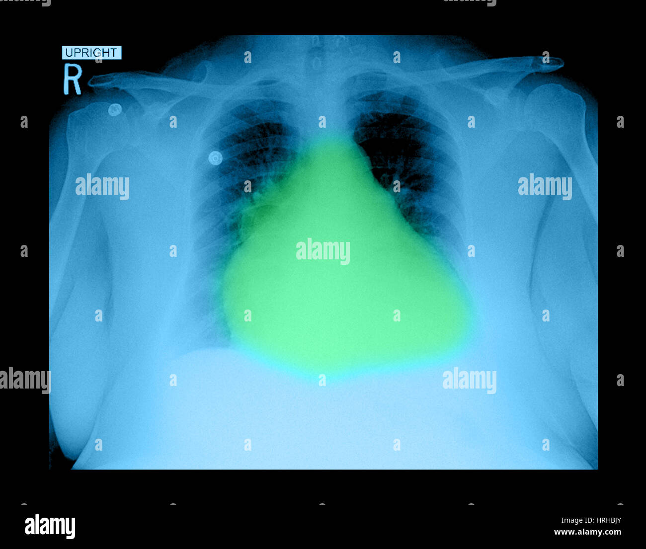 Enlarged Heart X Ray Chest X Ray Of A Newborn (a) Presenting With