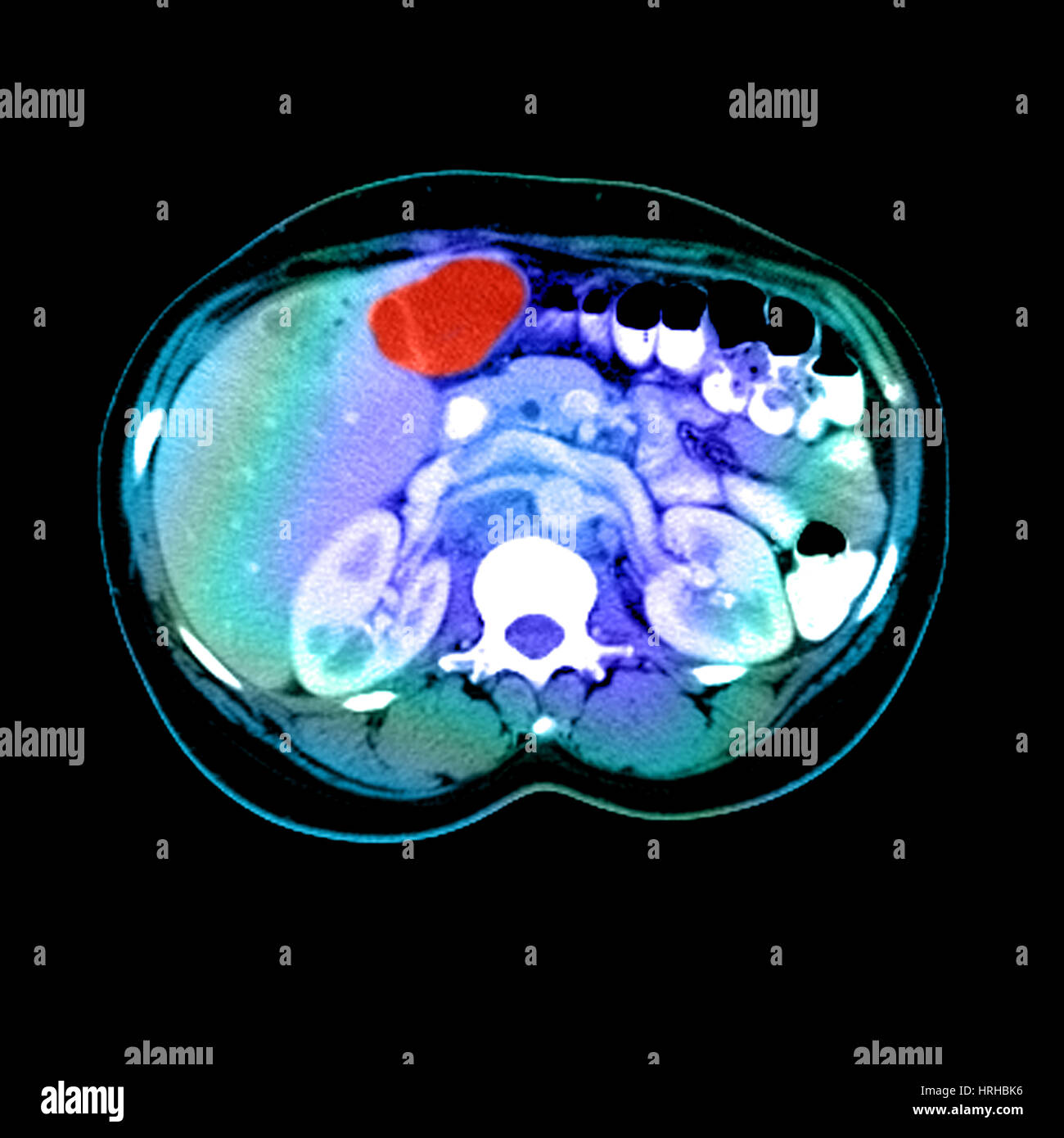 CT Scan of a Liver Tumor Stock Photo - Alamy