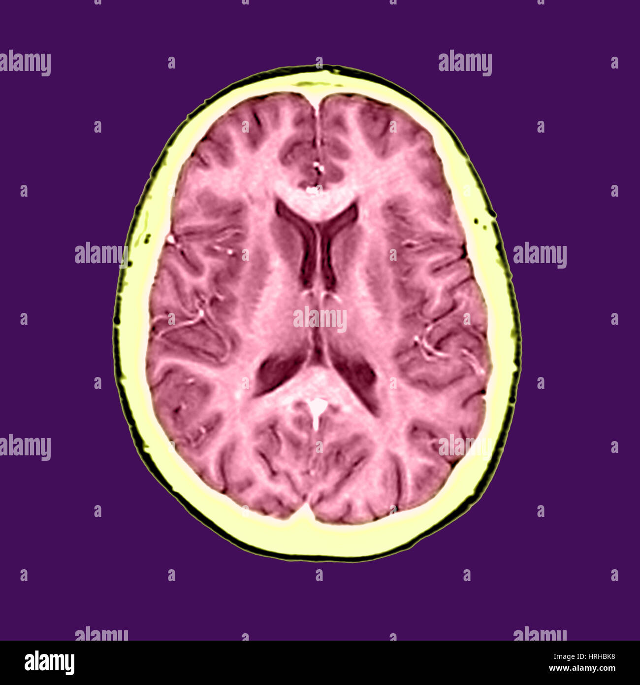 Normal brain, mri scans hi-res stock photography and images - Alamy