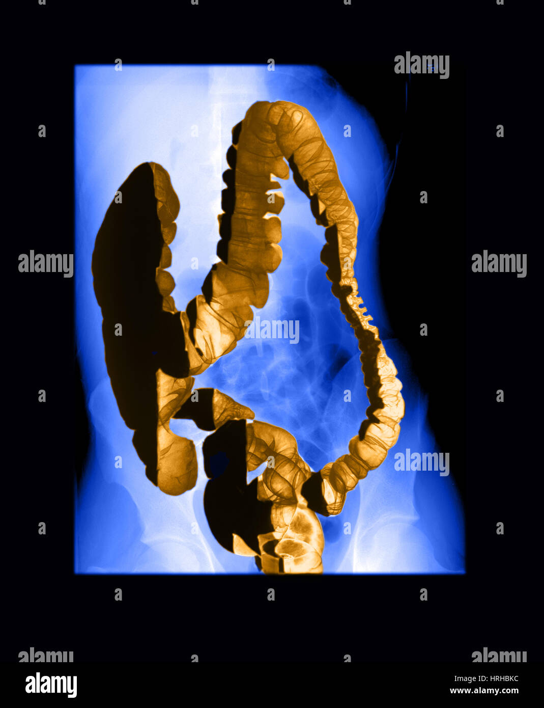 Normal Double Contrast Barium Enema Stock Photo - Alamy