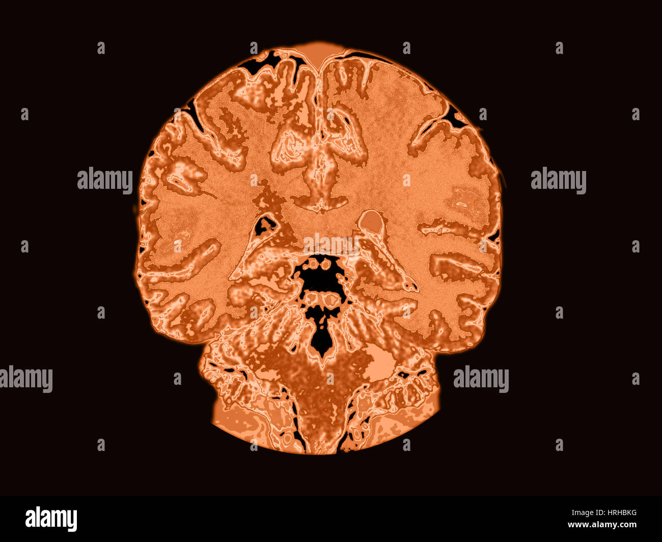 Coronal View MRI of Normal Brain Stock Photo - Alamy